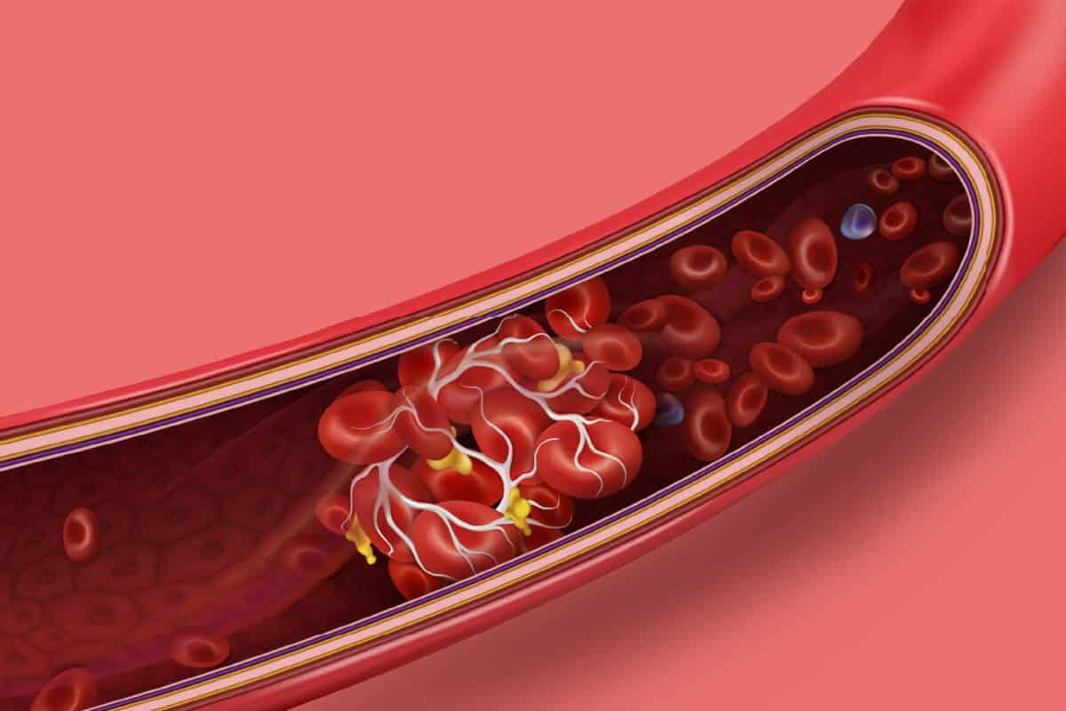 Vascular Conditions - Vascular Institute of Chattanooga