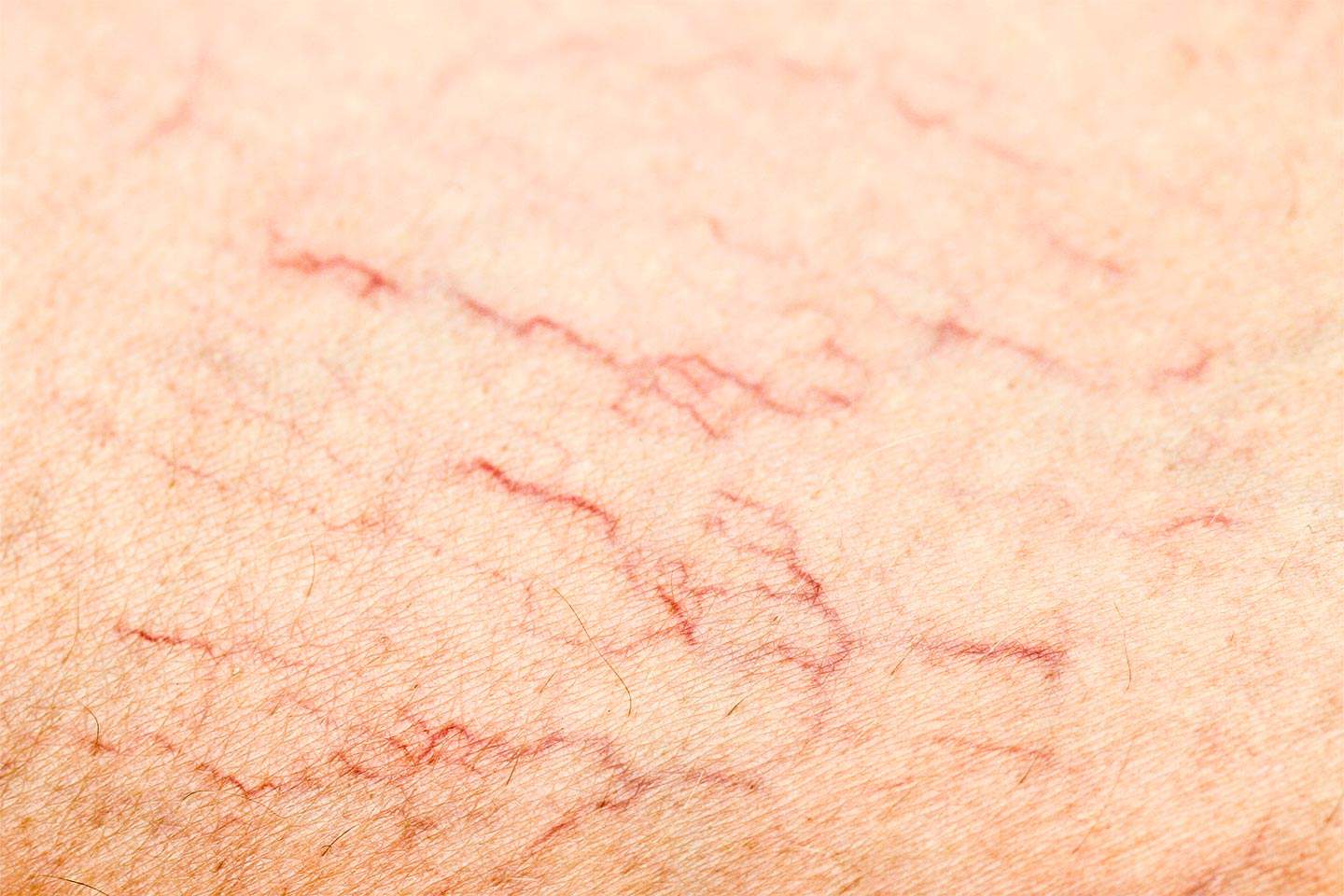 Spider Veins - Symptoms, Treatment, & Care at VIC Chattanooga