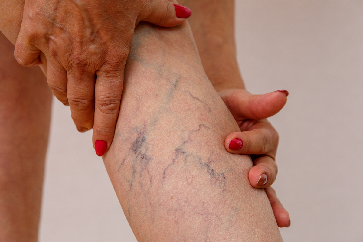 Why Are My Ankles Turning Brown? | Hyperpigmentation & Vein Disease